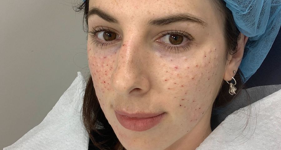 I tried the Korean ‘salmon sperm’ Rejuran facial