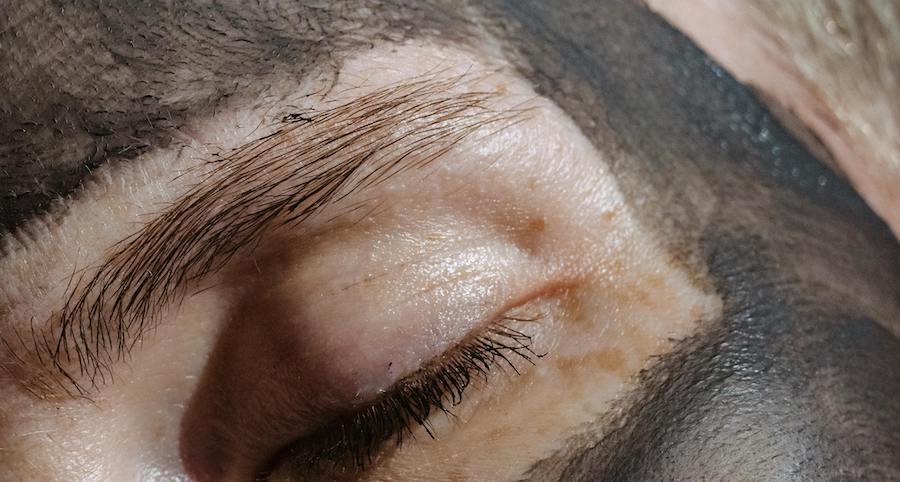 I tried a Carbon Laser blackhead extraction facial